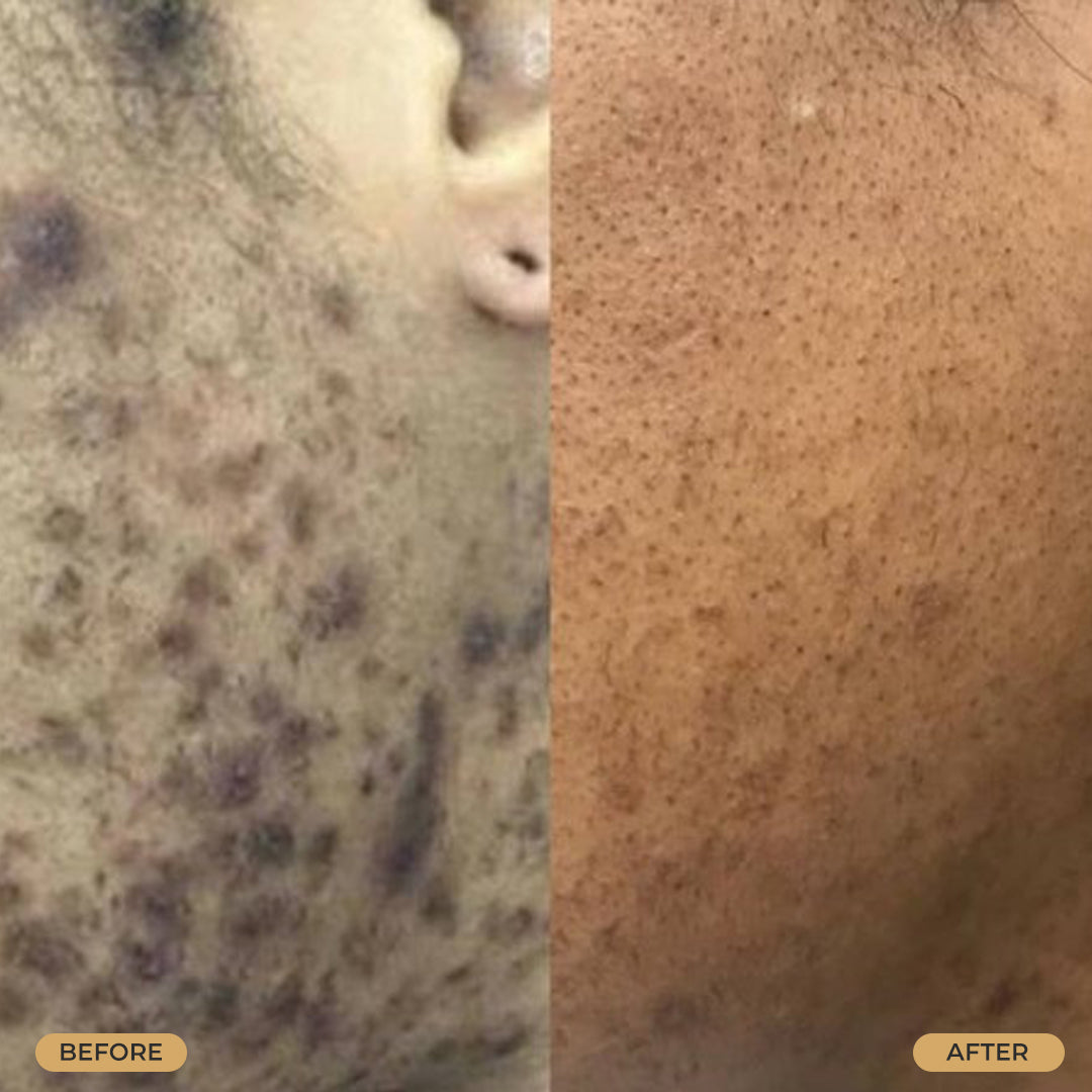 Combat Ingrown Hairs, Razor Bumps, Stretch Marks and Dry Skin – Skin Tight